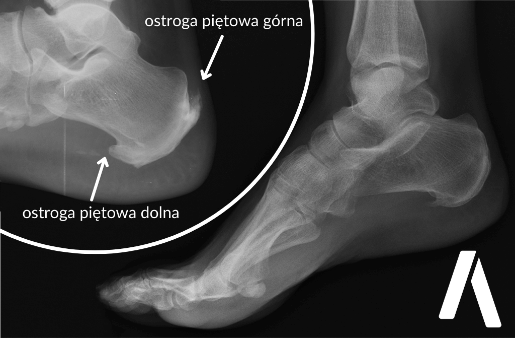 Ostroga piętowa - co to jest? dlaczego powstaje? | Fizjomate
