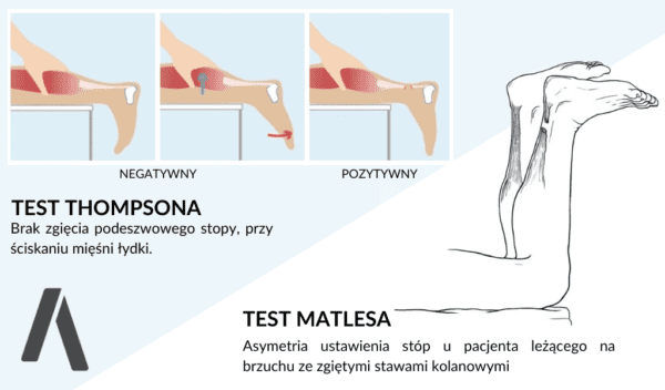 Zerwanie ścięgna Achillesa - objawy, rehabilitacja | Fizjomate